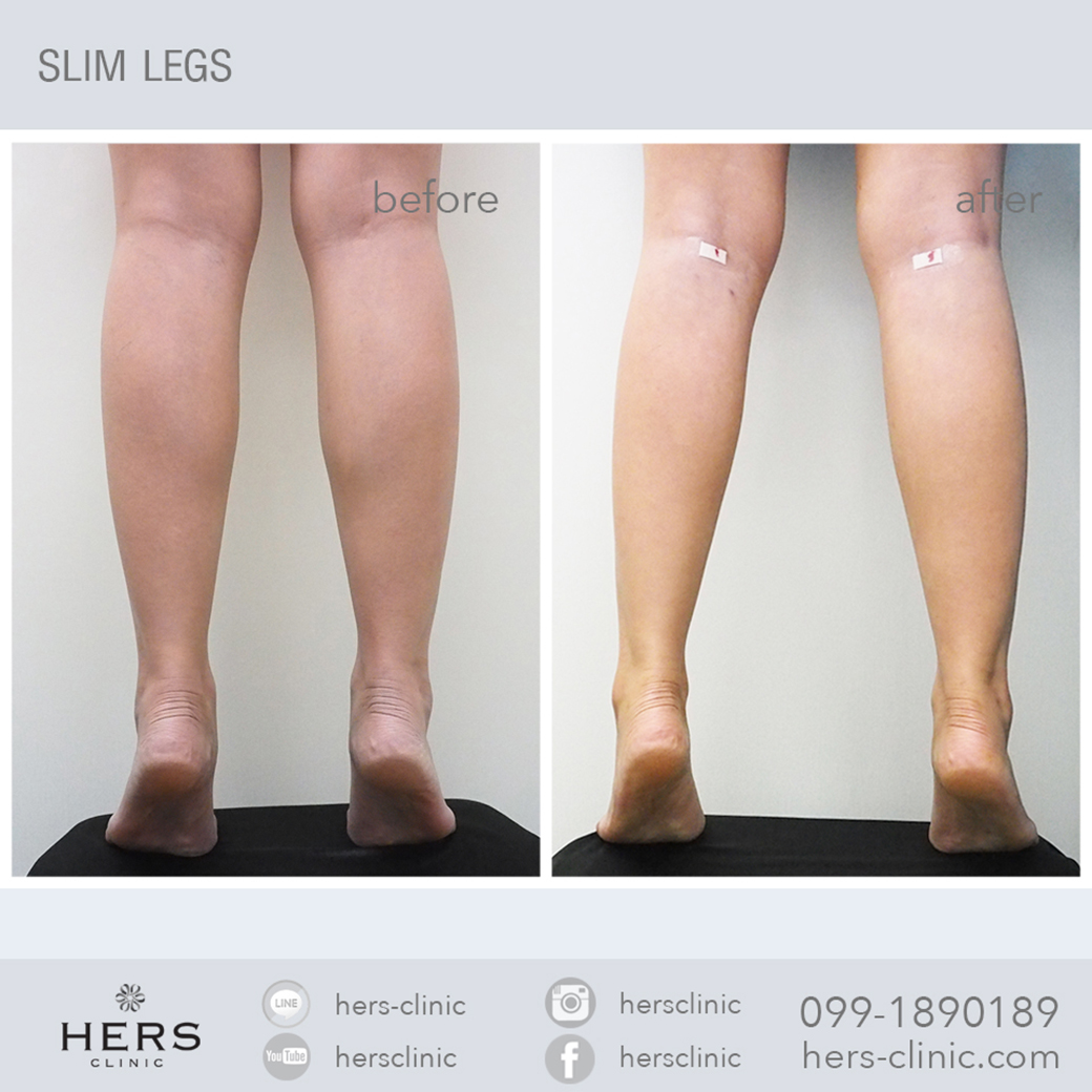 Calf Reduction ศัลยกรรมน่องเรียว ขาเรียว | HERS clinic
