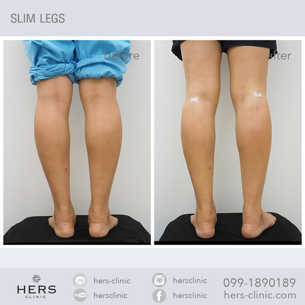 Calf Reduction ศัลยกรรมน่องเรียว ขาเรียว | HERS clinic
